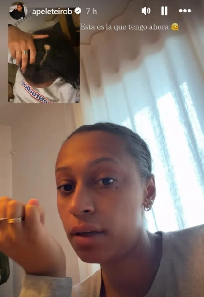 Los problemas de alopecia de Ana Peleteiro en el embarazo que relaciona ...